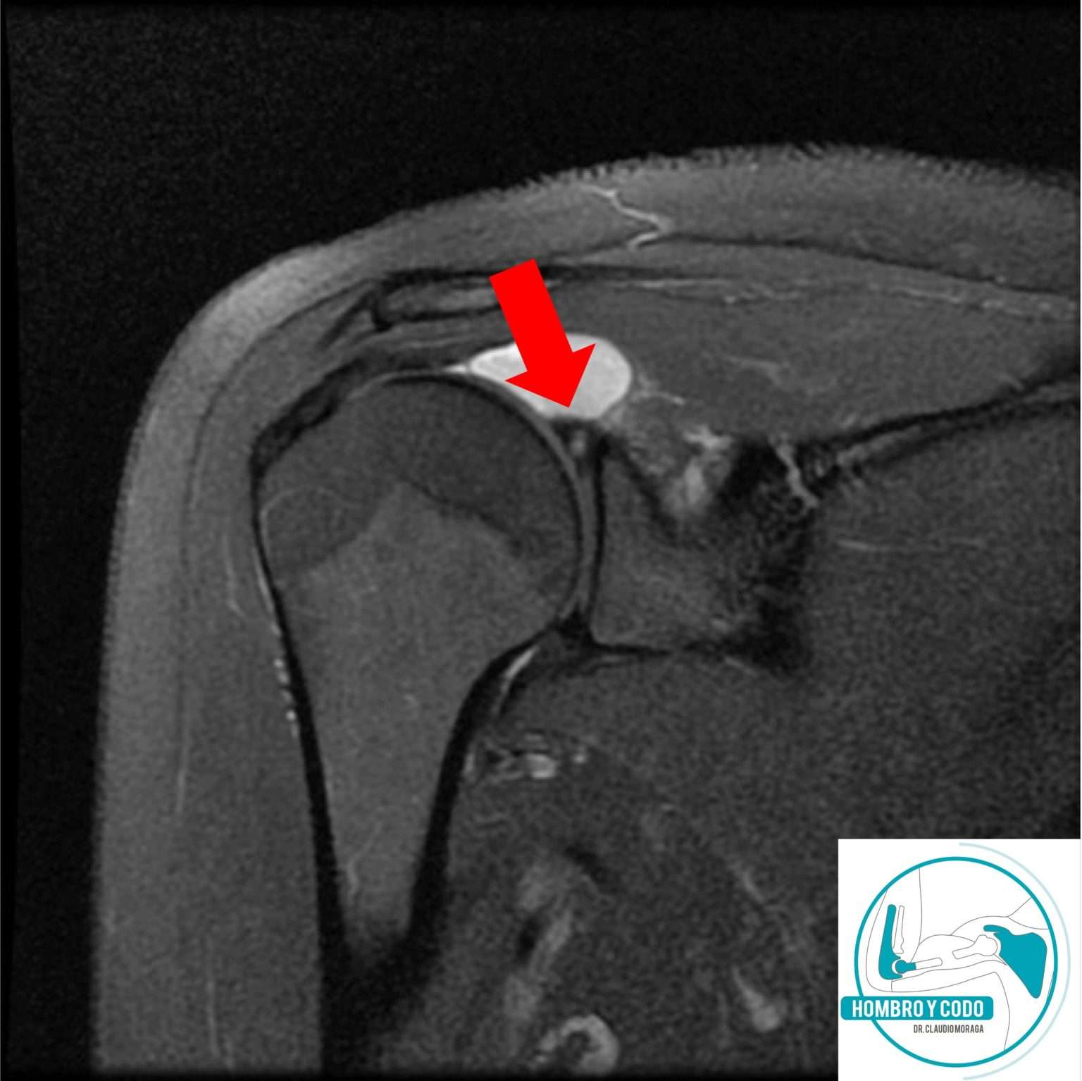 Lesión SLAP: rotura del labrum superior del hombro
