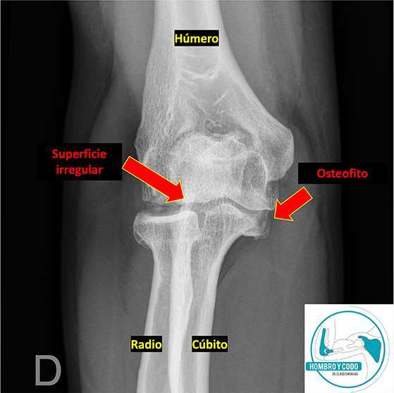 Radiografía De La Anatomía Del Codo Fractura De Cúpula Radial: