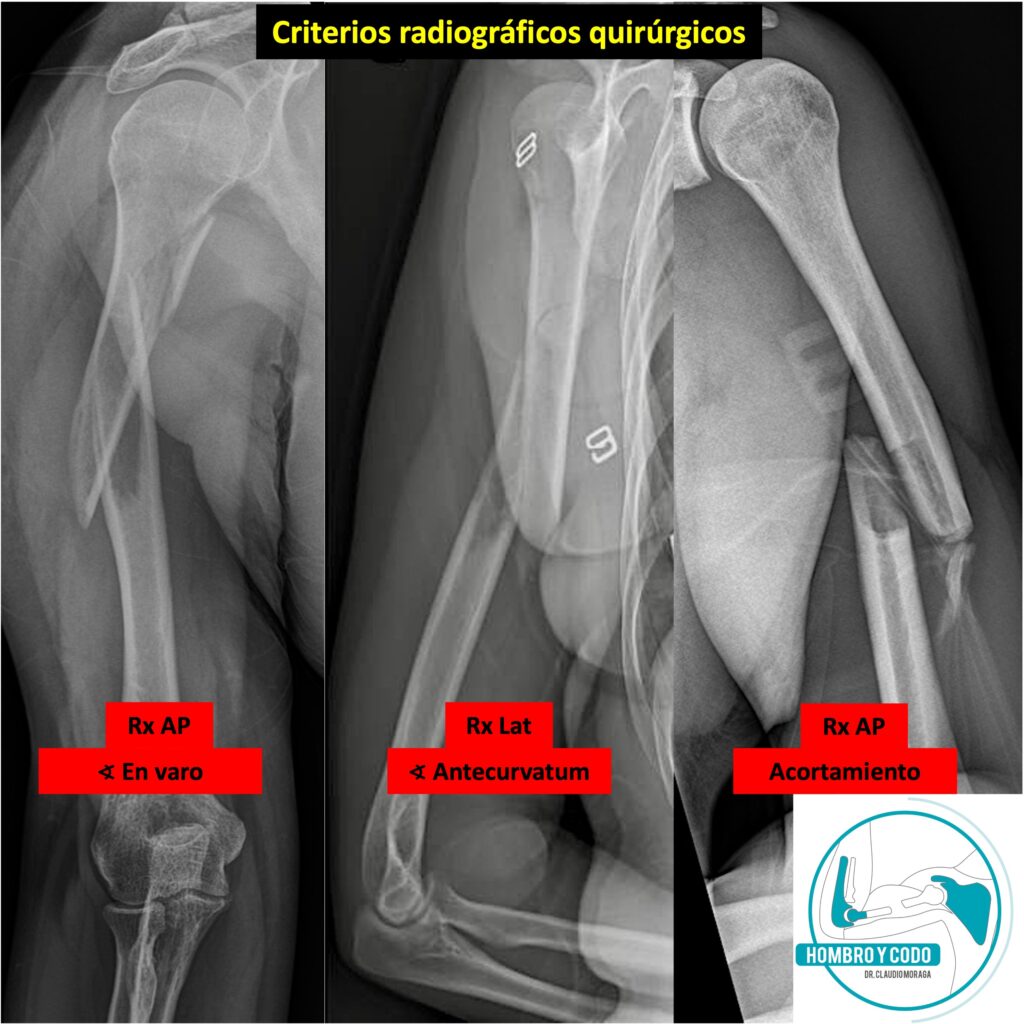 Anatomía De Rayos X Del Húmero Anatomía Radiológica: Rayos X, TAC,